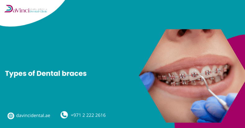 Types of Dental Braces: Which One Is Right for You?