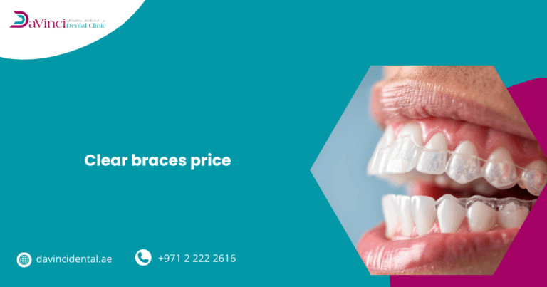 Clear Braces Price In Abu Dhabi - Davinci Clinic